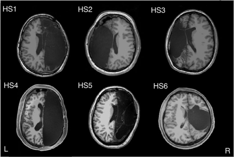 Living with half a brain - Mapping Ignorance