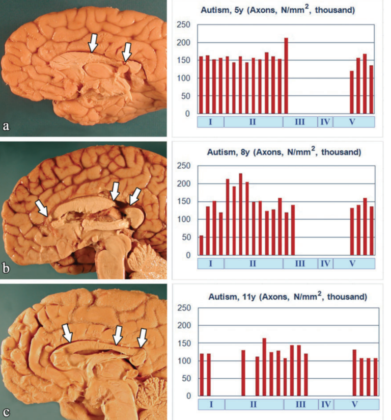 Corpus Callosum And Autism Mapping Ignorance
