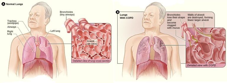 Health-related quality of life in chronic obstructive pulmonary disease ...